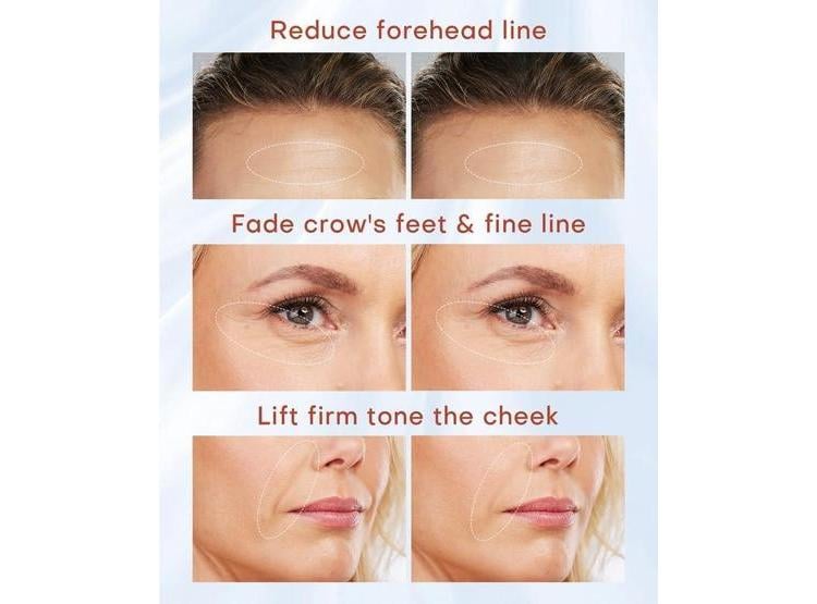 MLAY MÁQUINA DE BELLEZA RF, DISPOSITIVO PARA REDUCIR ARRUGAS Y ...